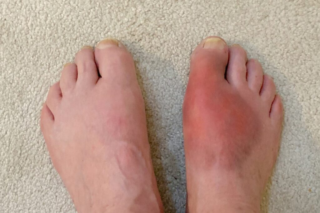 Probenecid Treatment For Gout: Everything You Need To Know - Alpha ...